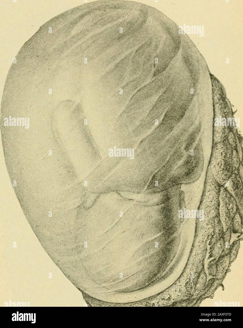 Premature rupture of the membranes hi-res stock photography and images ...