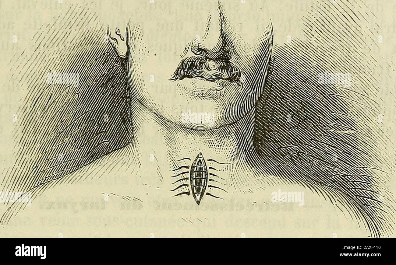 Points de suture dans la peau hi-res stock photography and images - Alamy