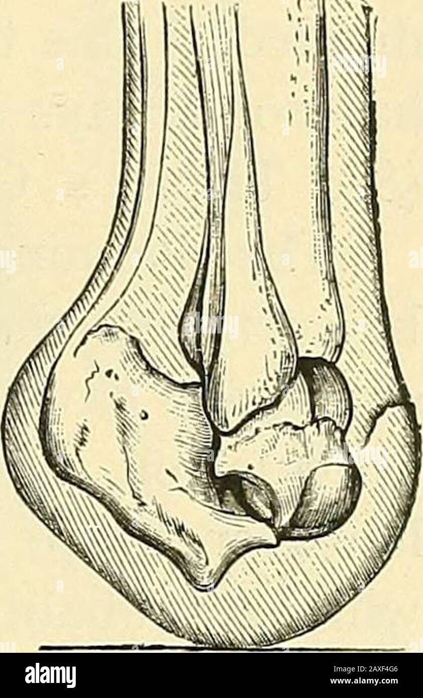 Symes amputation hi-res stock photography and images - Alamy