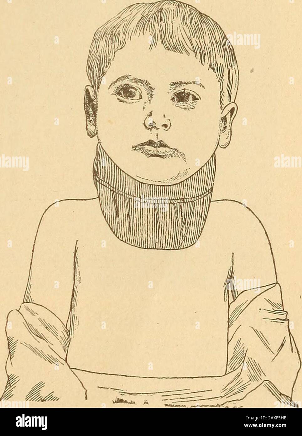 Lectures on orthopedic surgery . Fig. 61.—The Thomas collar. of this ...