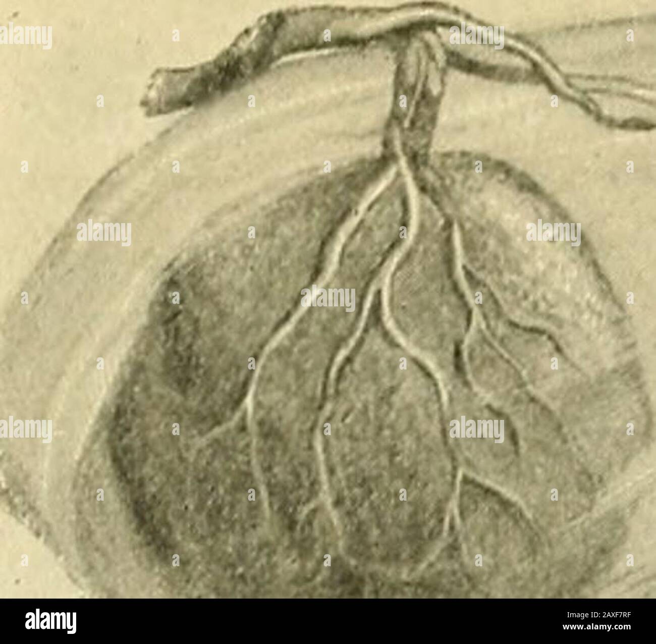 Placenta cord insertion hi-res stock photography and images - Alamy