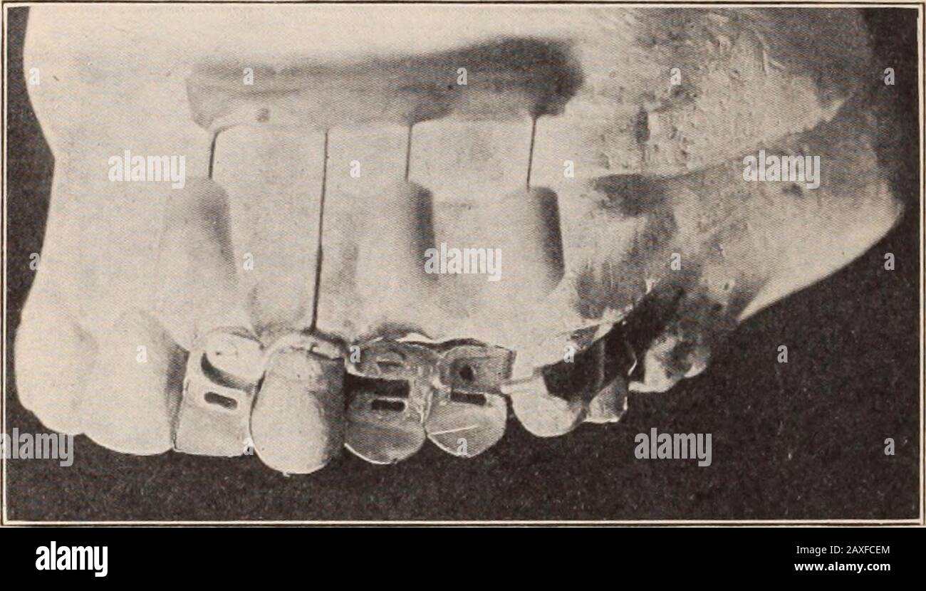 Dental trim hi-res stock photography and images - Alamy