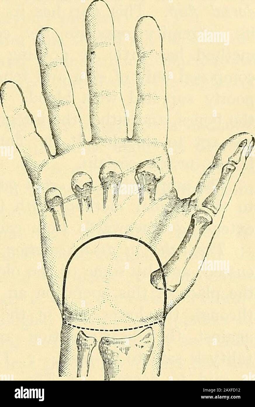 Transverse Arch In Hand