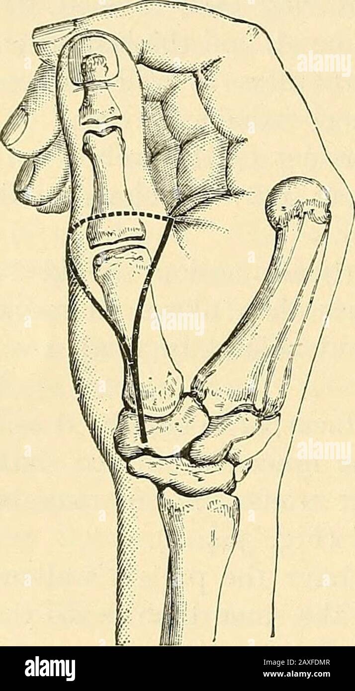 Palmar incision hi-res stock photography and images - Alamy
