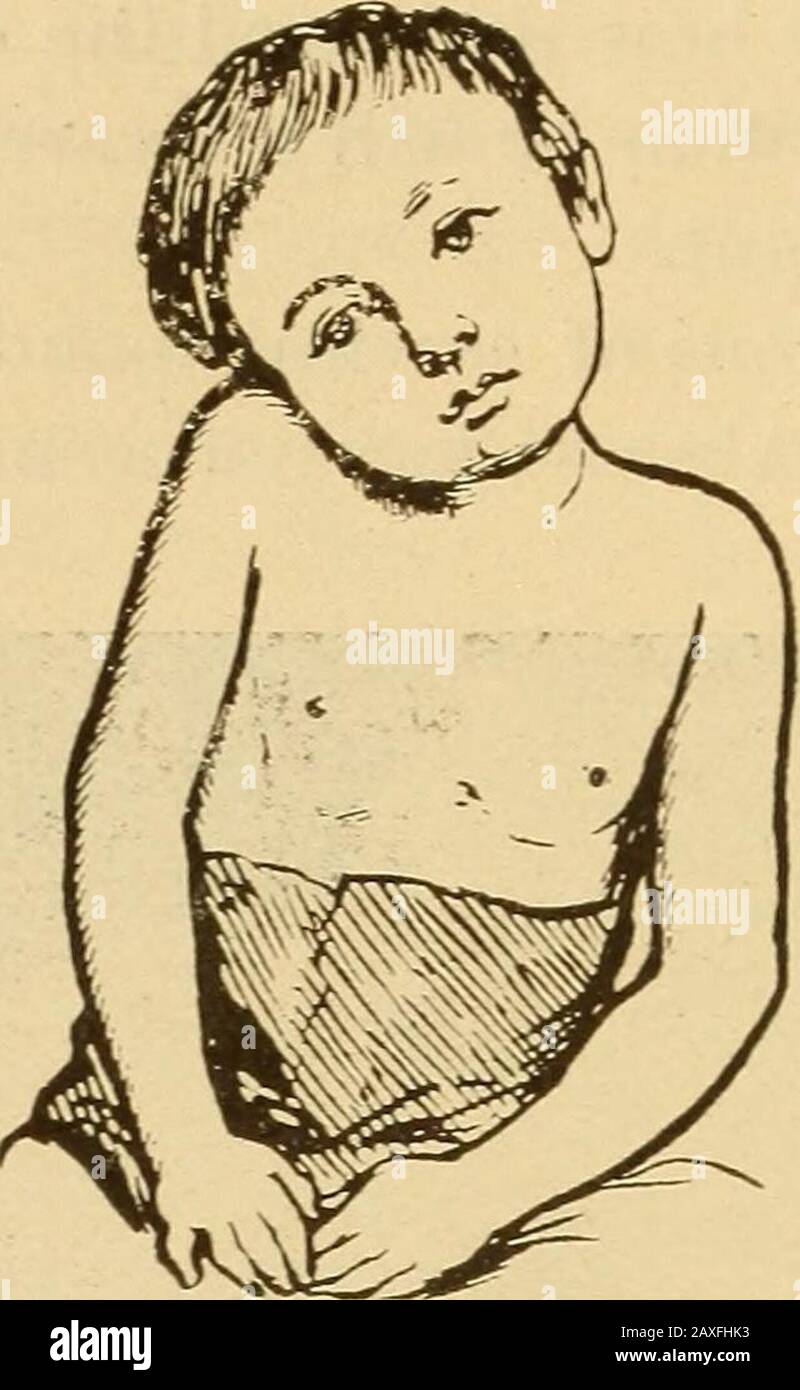 Formation of an abscess hi-res stock photography and images - Alamy