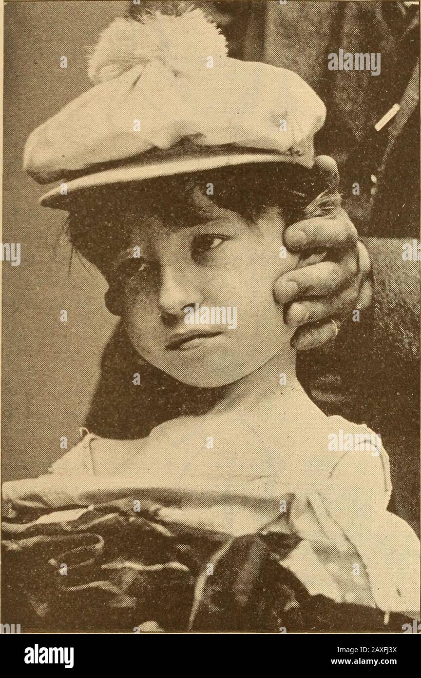 Lectures on orthopedic surgery . Fig. 10.—The same case showu in Fig. y ...