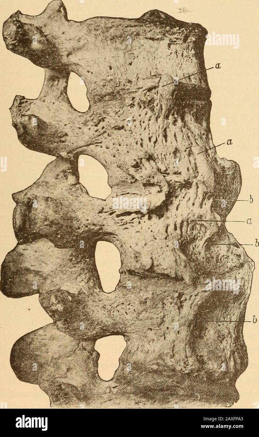 Spine deformities hi-res stock photography and images - Alamy