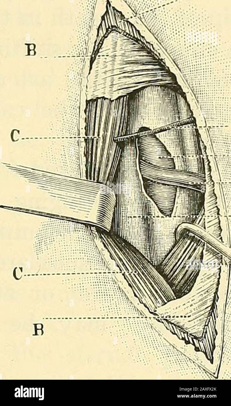A manual of operative surgery . en defined, and the situationof the ...