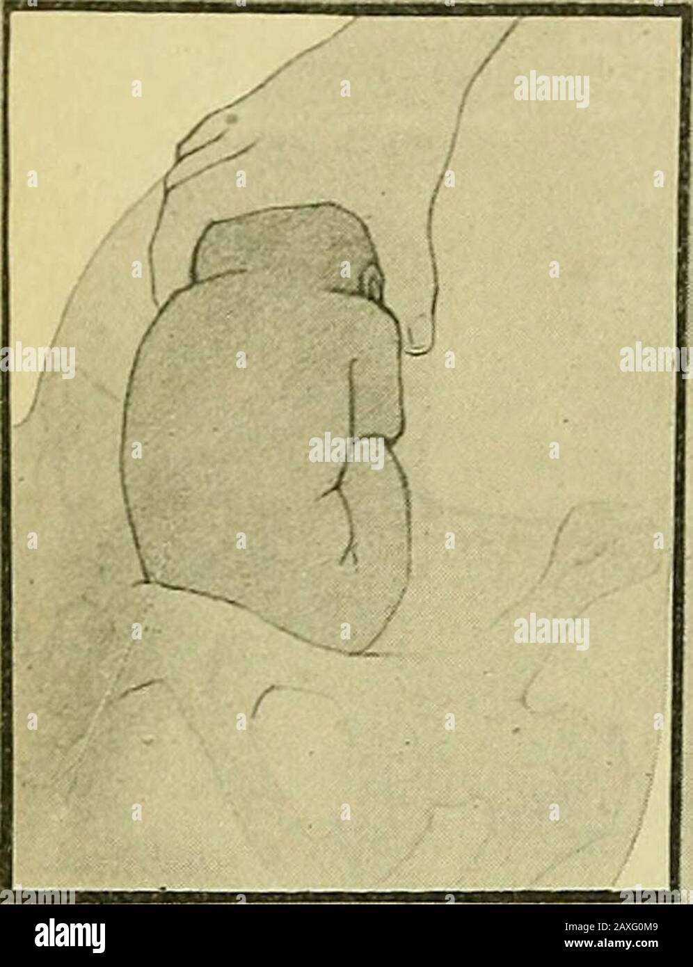 Occiput posterior hi-res stock photography and images - Alamy