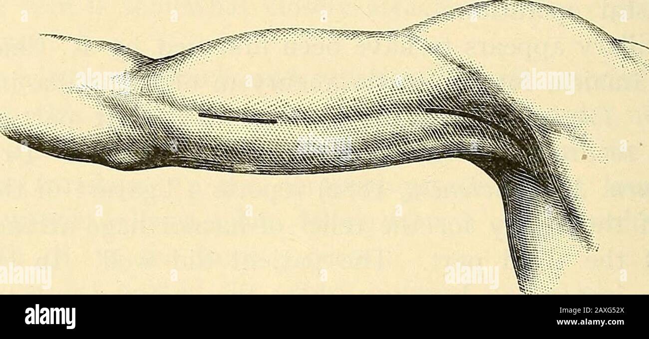 A manual of operative surgery . arm is at right angles to the body,and ...