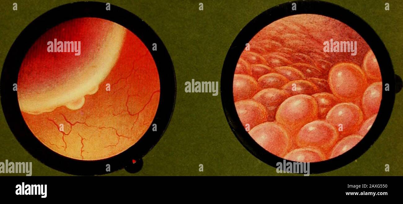 Bullous hi-res stock photography and images - Alamy