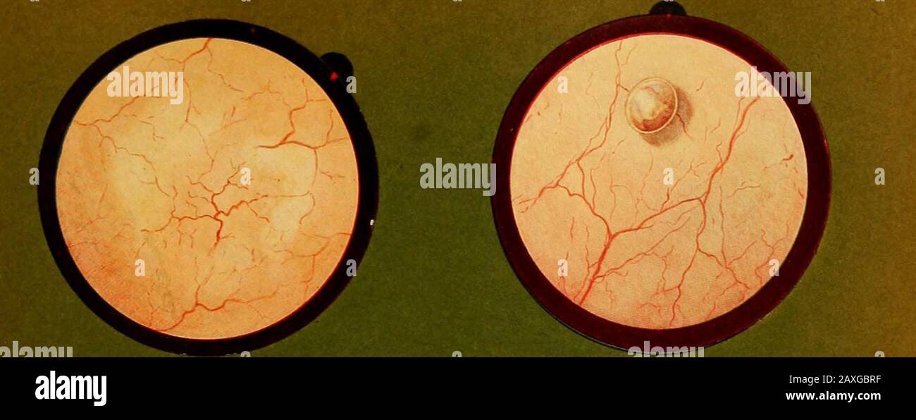 Traitâe pratique de cystoscopie et de cathâetâerisme urâetâeral . Fig ...