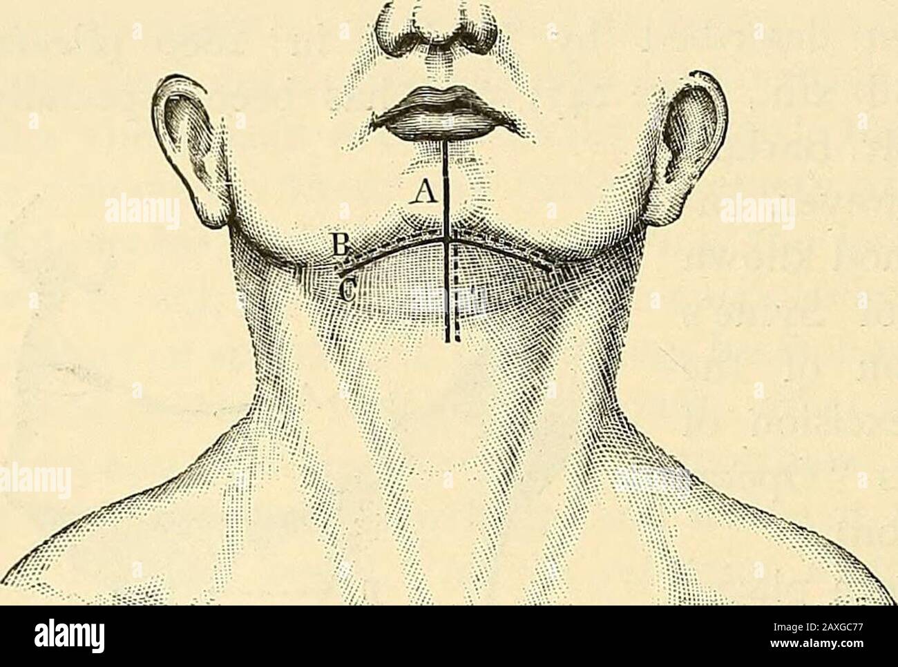 Tracheotomy tube hi-res stock photography and images - Alamy