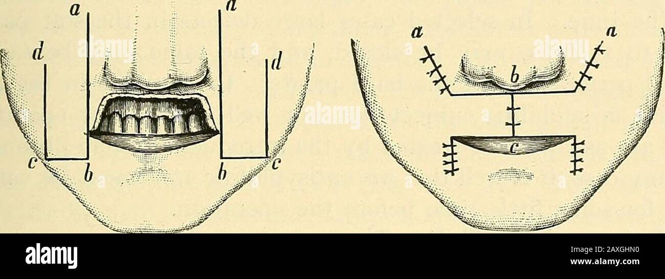 Upper lip raised hi-res stock photography and images - Alamy