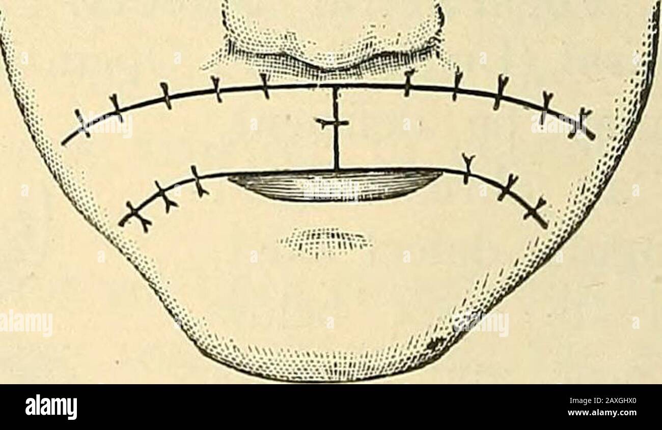 A manual of operative surgery . FIG. 272.—RESTORATION OF THE UPPER LIP ...