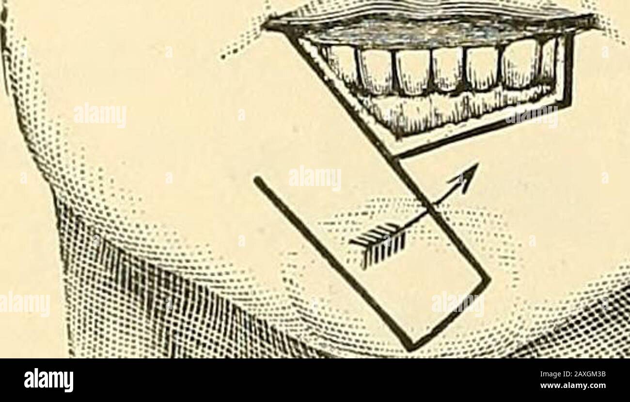 A manual of operative surgery . FIG. 265.—RESTORATION OF THE LOWER LIP ...