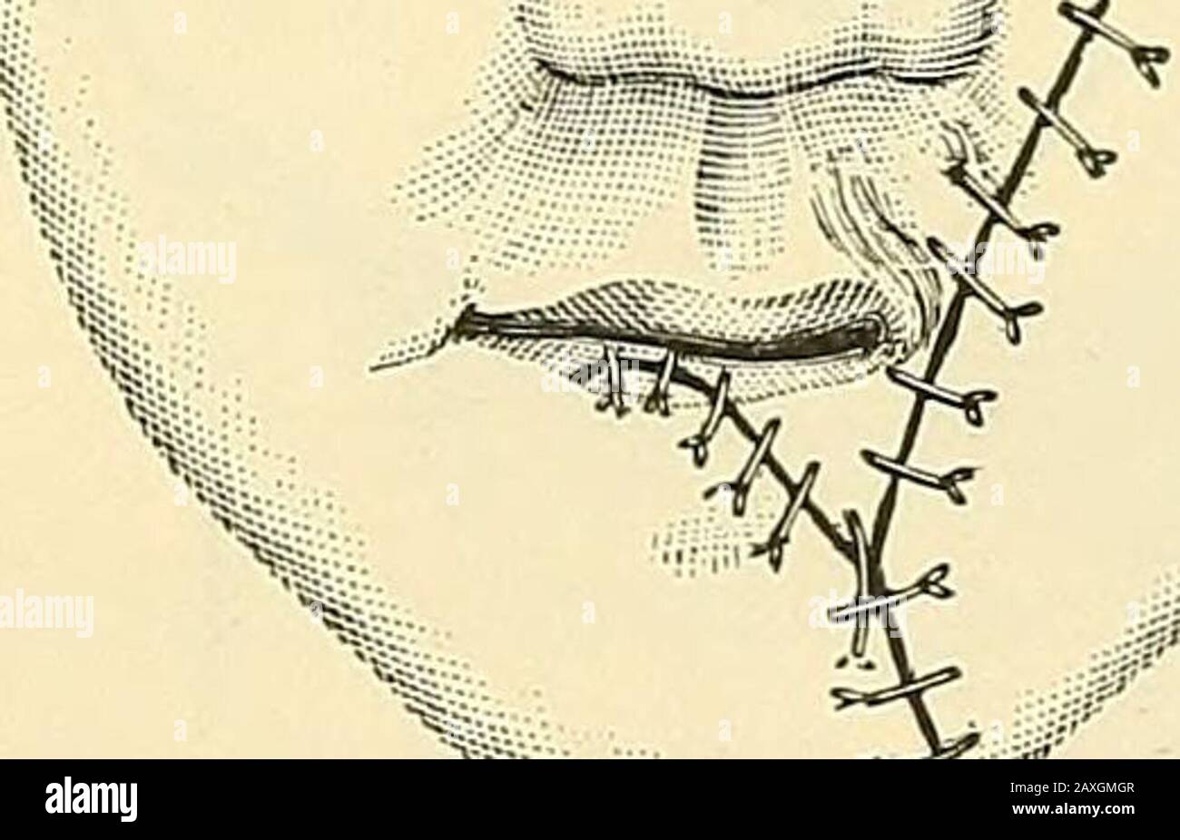 Stitches lip hi-res stock photography and images - Alamy