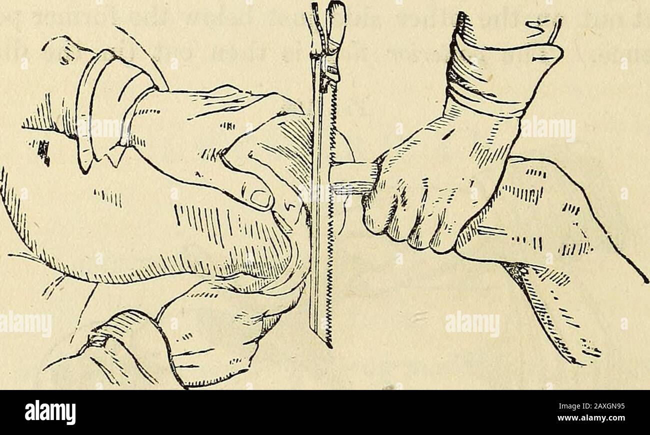 Anterior posterior flaps hi-res stock photography and images - Alamy