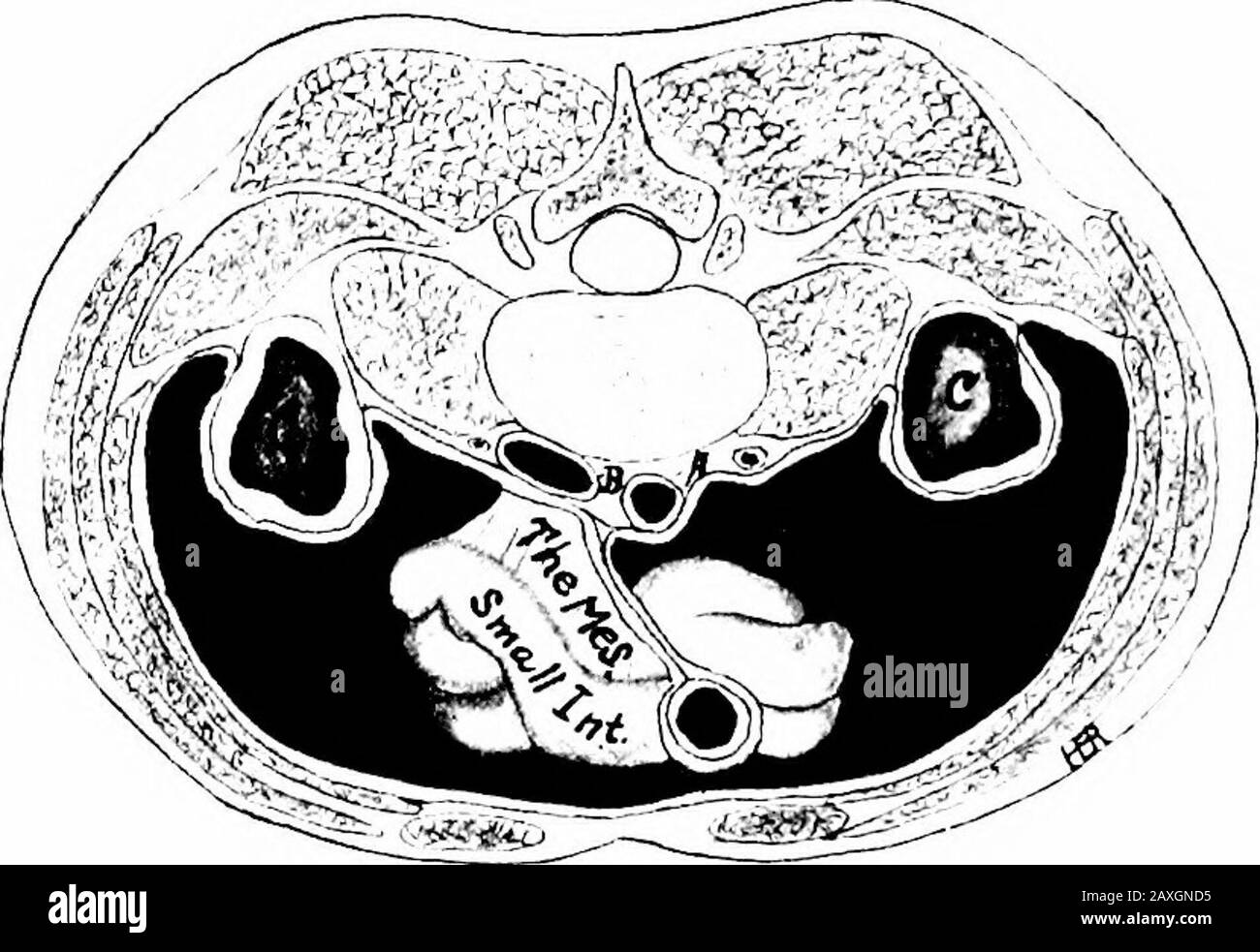 Transverse Mesocolon Pancreas