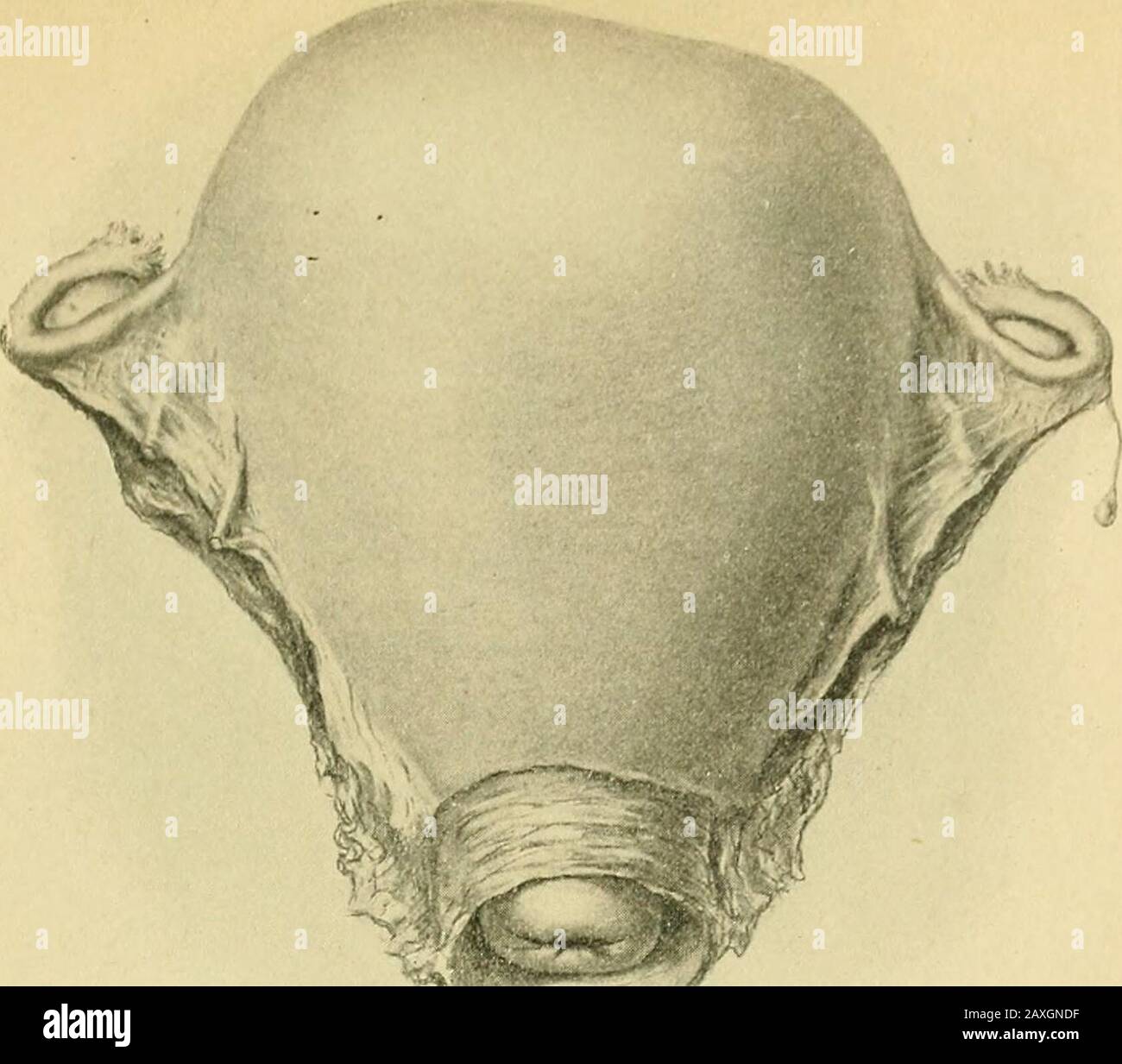 Retained placenta hi-res stock photography and images - Alamy