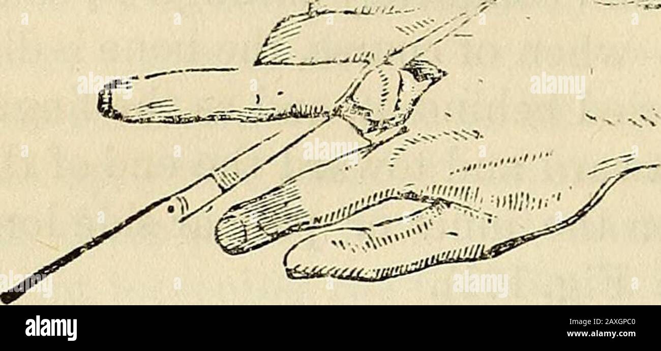 Circular amputation hi-res stock photography and images - Alamy