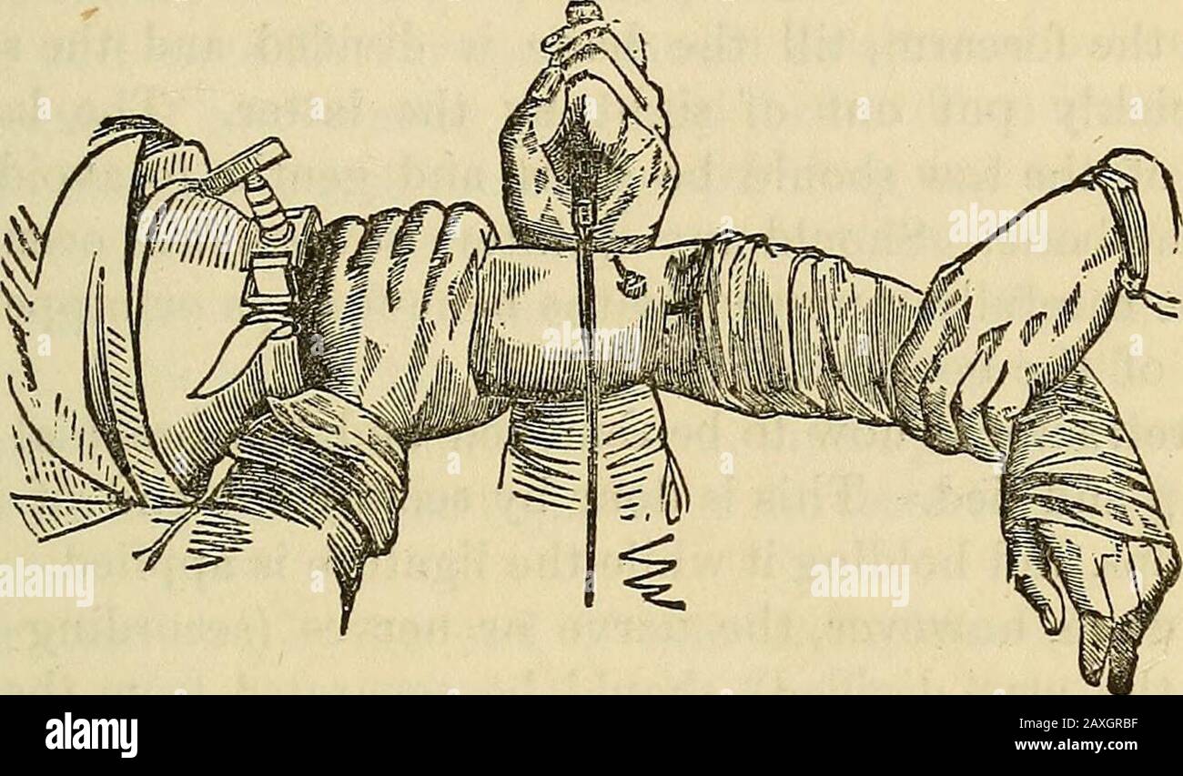 Elbow chair surgery hi-res stock photography and images - Alamy