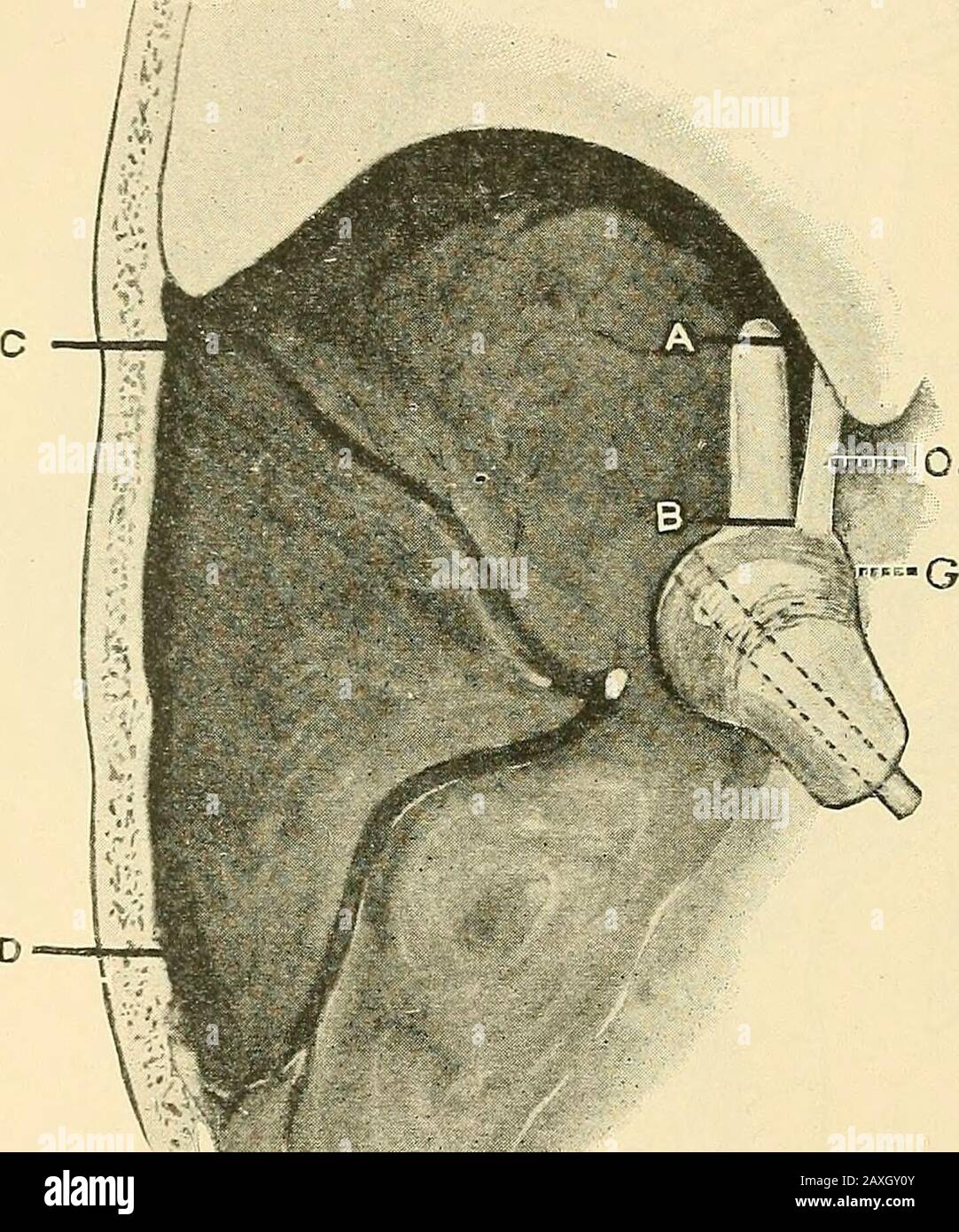 Excised palate hi-res stock photography and images - Alamy