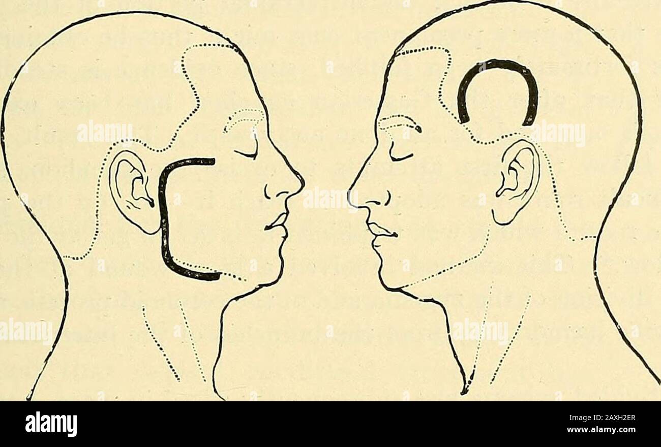 Peripheral neuralgia hi-res stock photography and images - Alamy