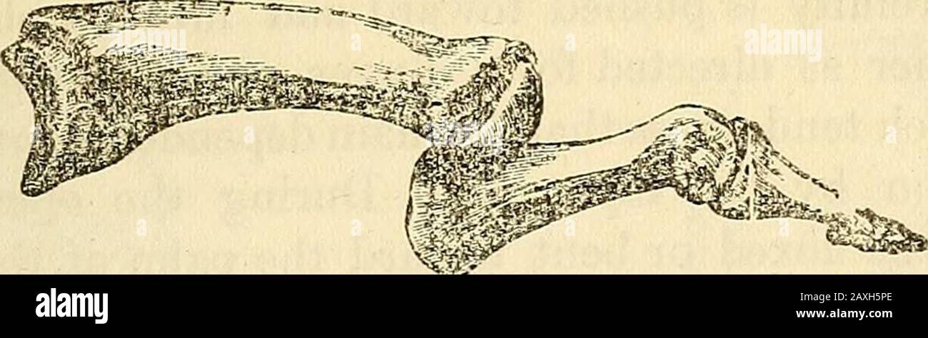 Thumb dislocation hi-res stock photography and images - Alamy