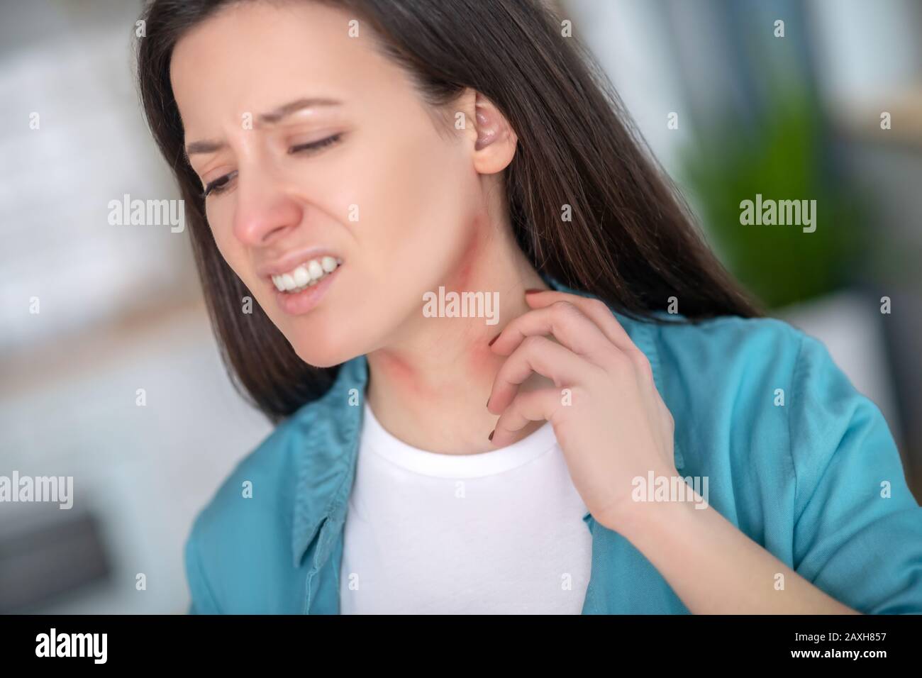 Woman having symptoms of allergy on her neck Stock Photo - Alamy
