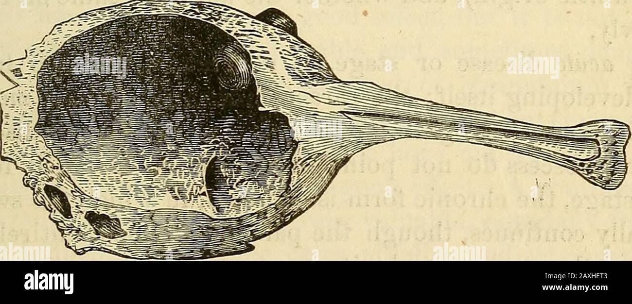 Lectures on the American eclectic system of surgery . Abscess of Bone ...