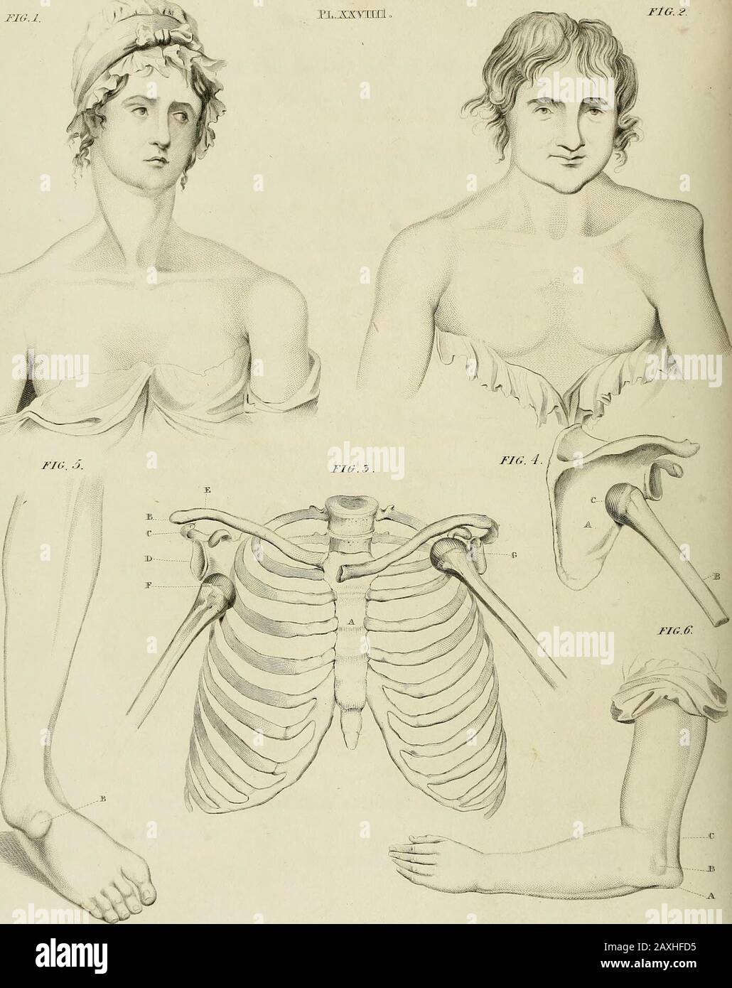 A treatise on dislocations and on fractures of the joints . Thomass ...