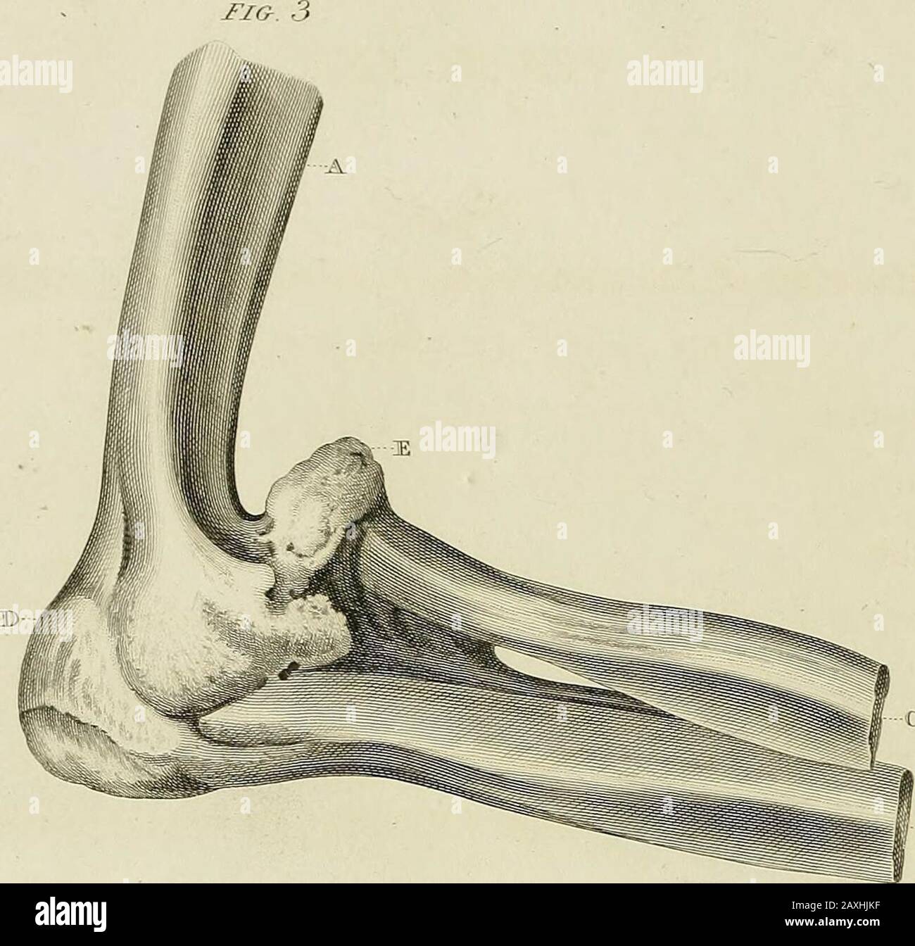 A treatise on dislocations and on fractures of the joints . PubHdicd V ...