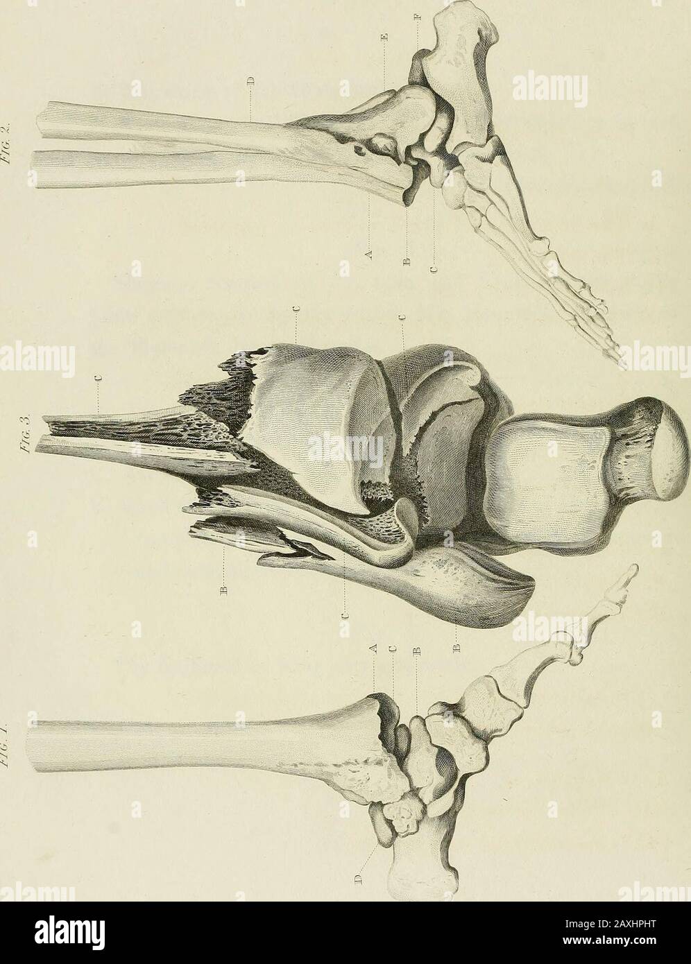 A treatise on dislocations and on fractures of the joints . the tibia ...