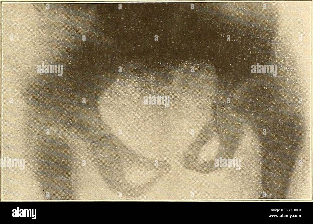 Röntgenbild fuss hi-res stock photography and images - Alamy