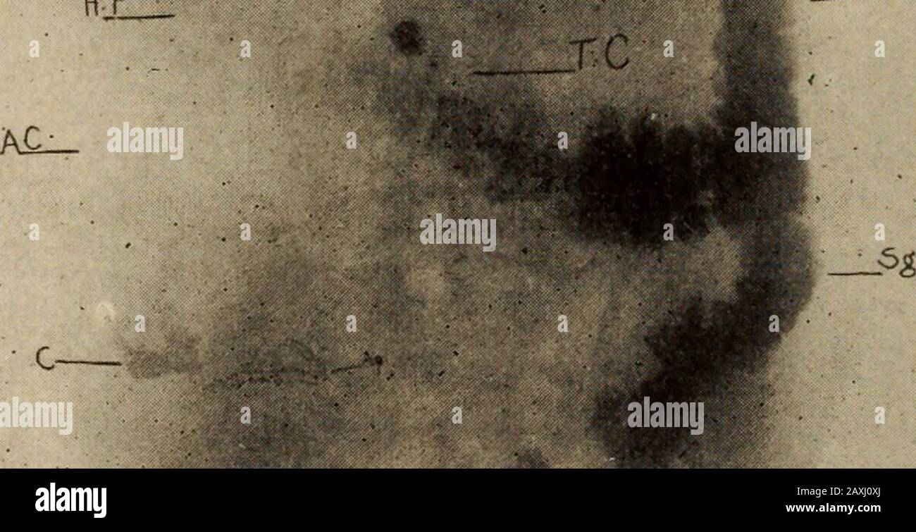 Pyelitis hi-res stock photography and images - Alamy