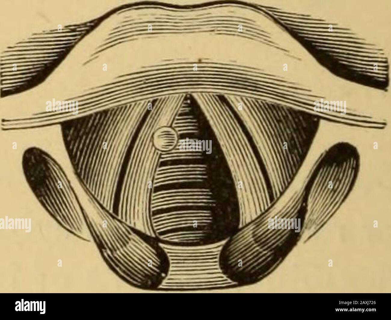 Vocal Polyps Pedunculated