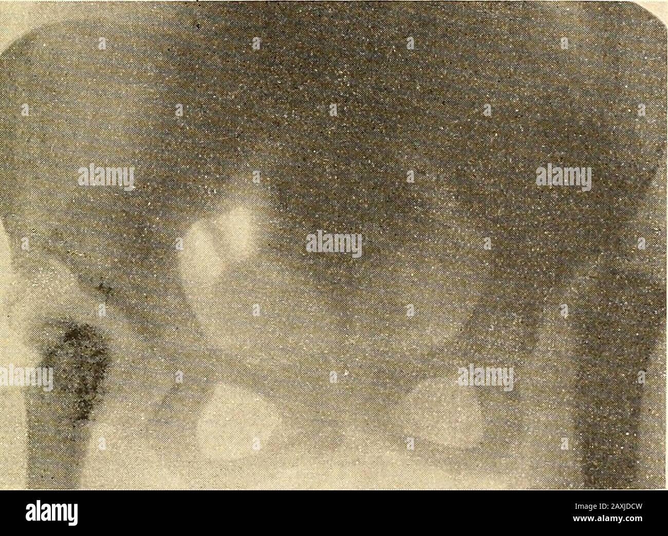 Ueber die Heilung der angeborenen Hüftgelenks-Verrenkung durch ...