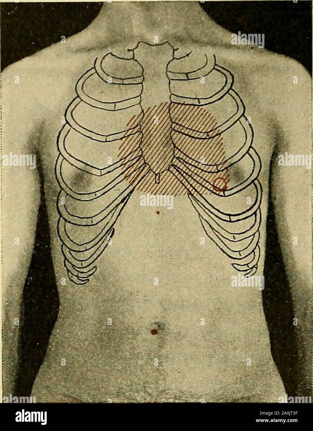 Inferior angle of scapula hi-res stock photography and images - Alamy
