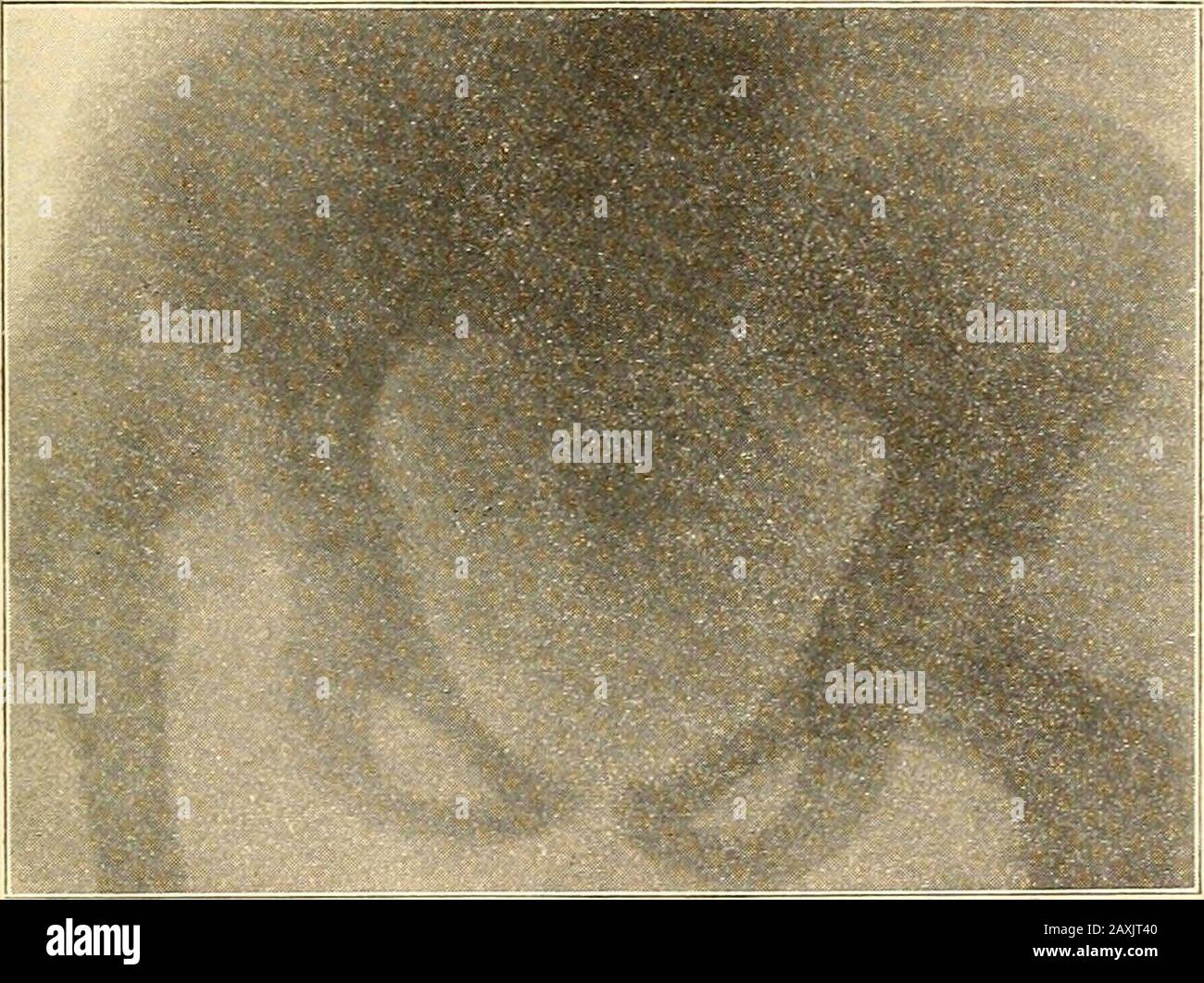 Anschwellungen hi-res stock photography and images - Alamy