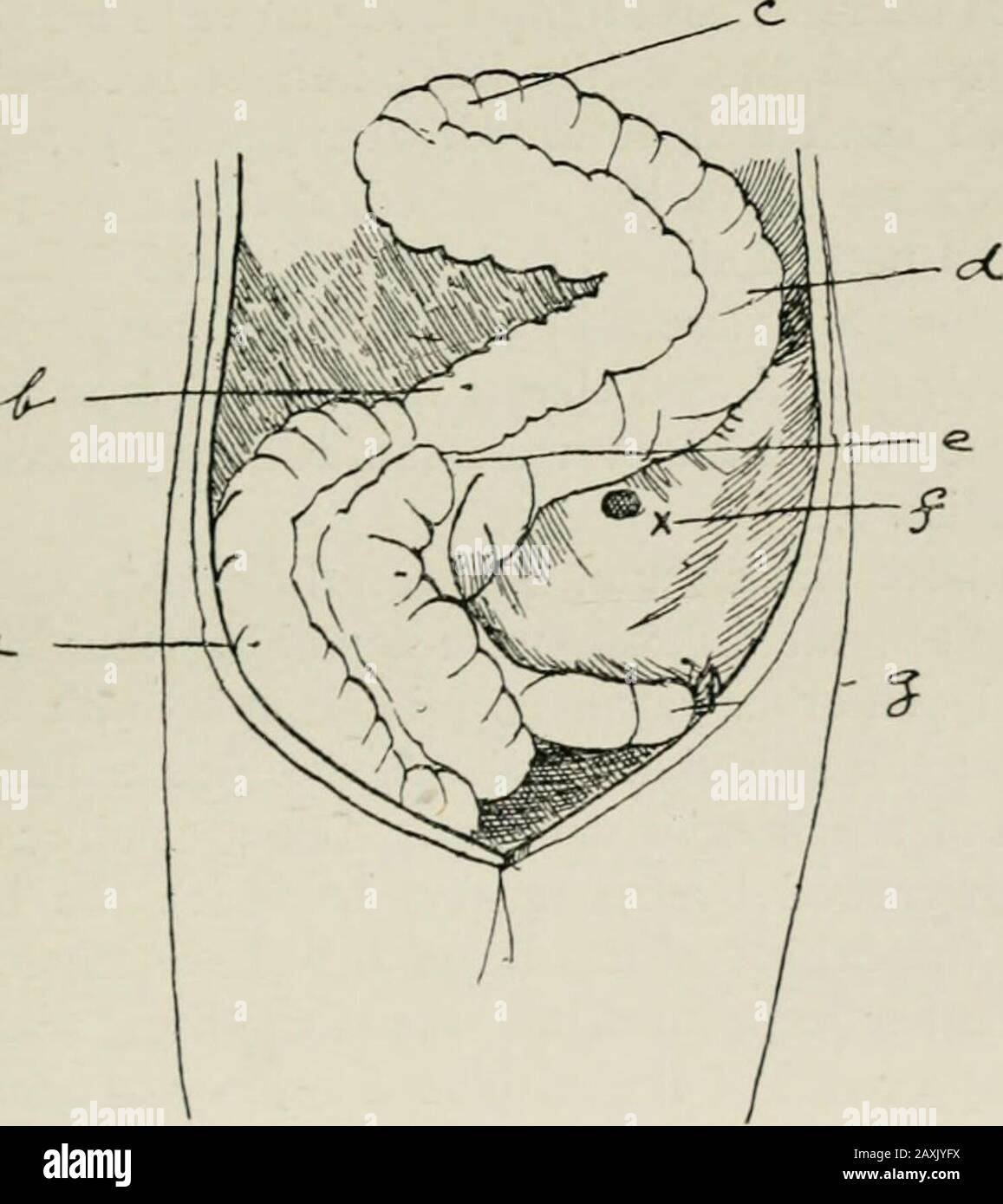 On retro-peritoneal hernia . wing condition : The intestines were ...