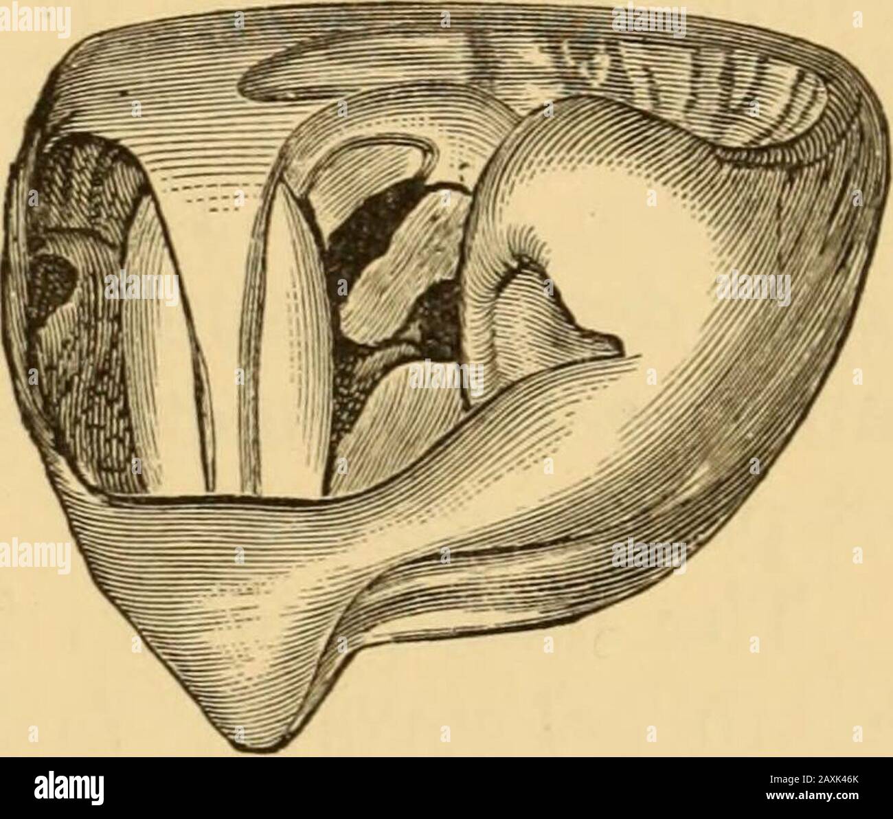 Oedema of larynx hi-res stock photography and images - Alamy