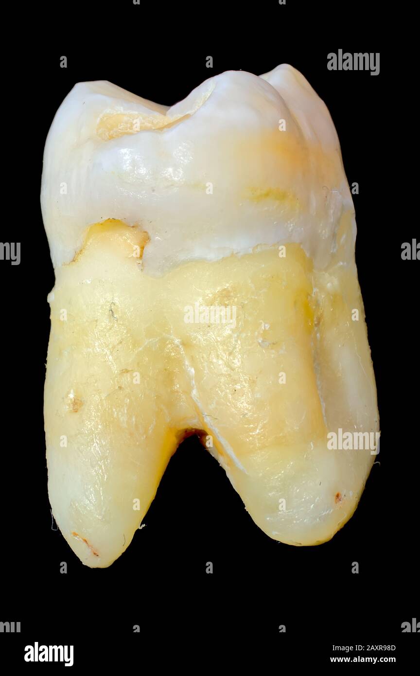 Cavity Side Of Molar