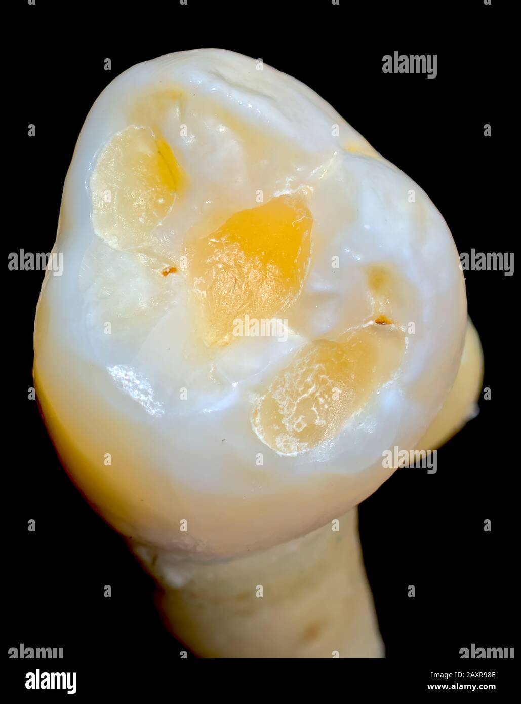 Decayed wisdom tooth hi-res stock photography and images - Alamy