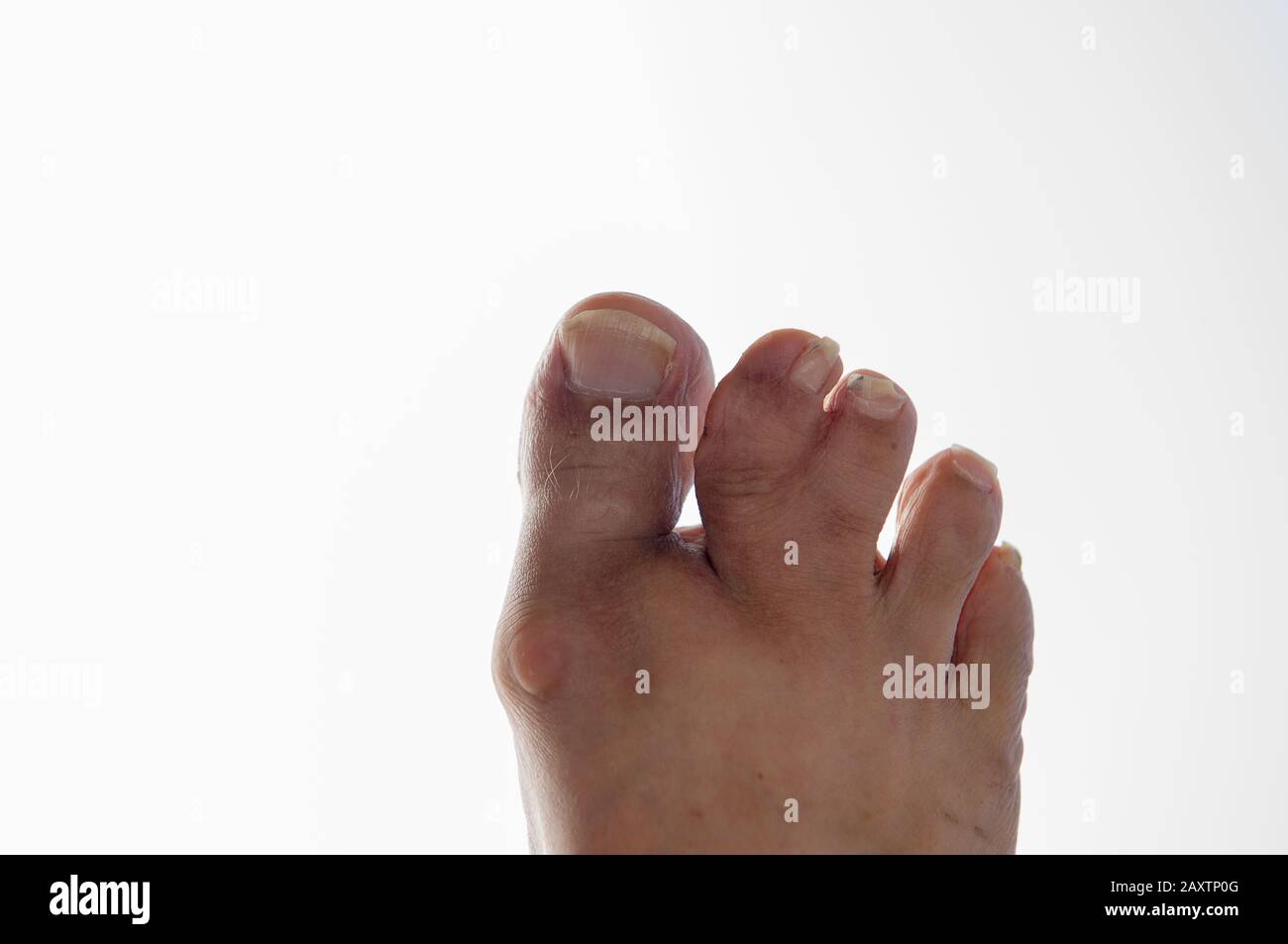 Human foot with conjoined toes Stock Photo - Alamy
