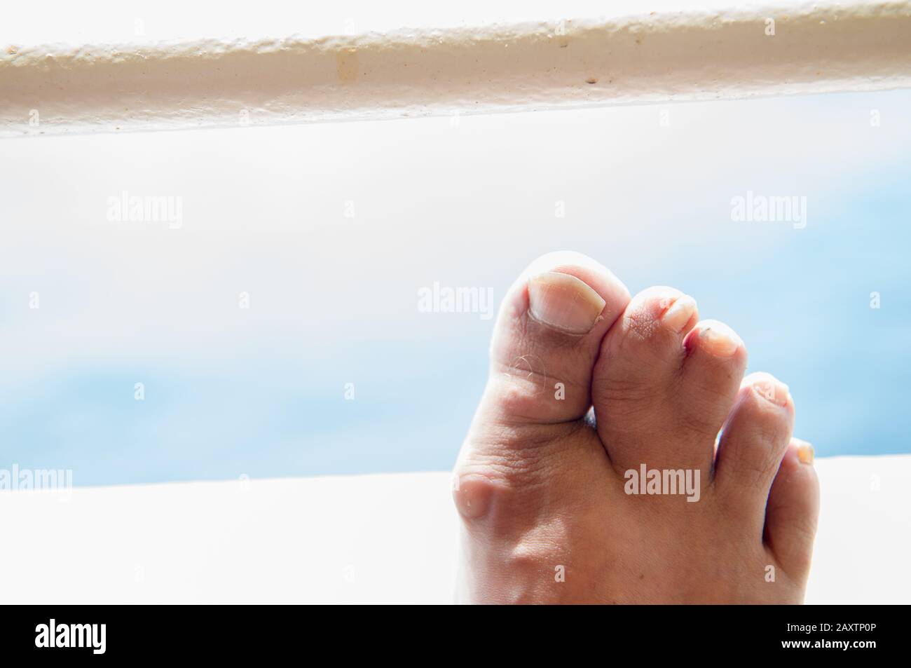 Human foot with conjoined toes Stock Photo - Alamy