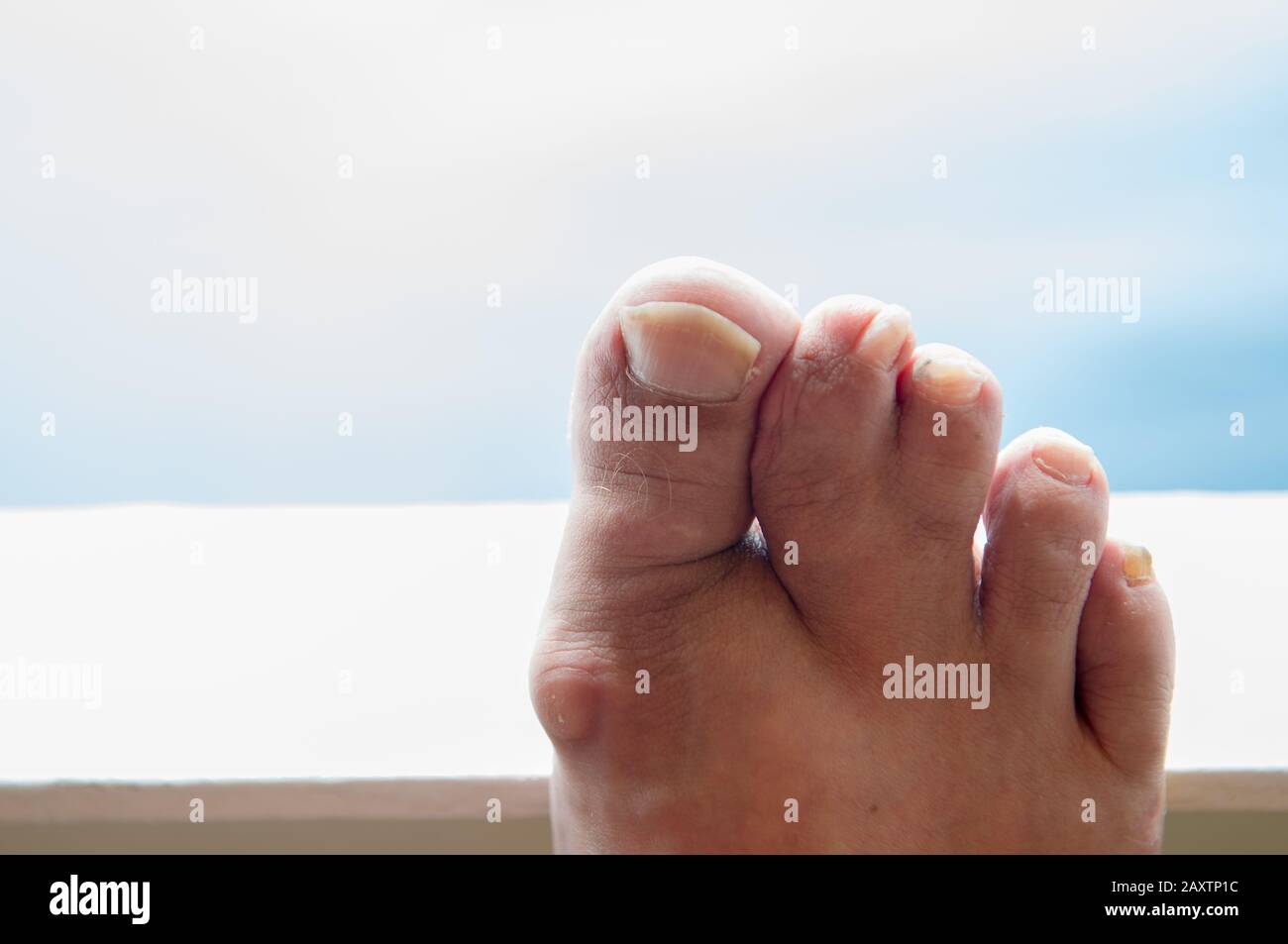 Human foot with conjoined toes Stock Photo - Alamy
