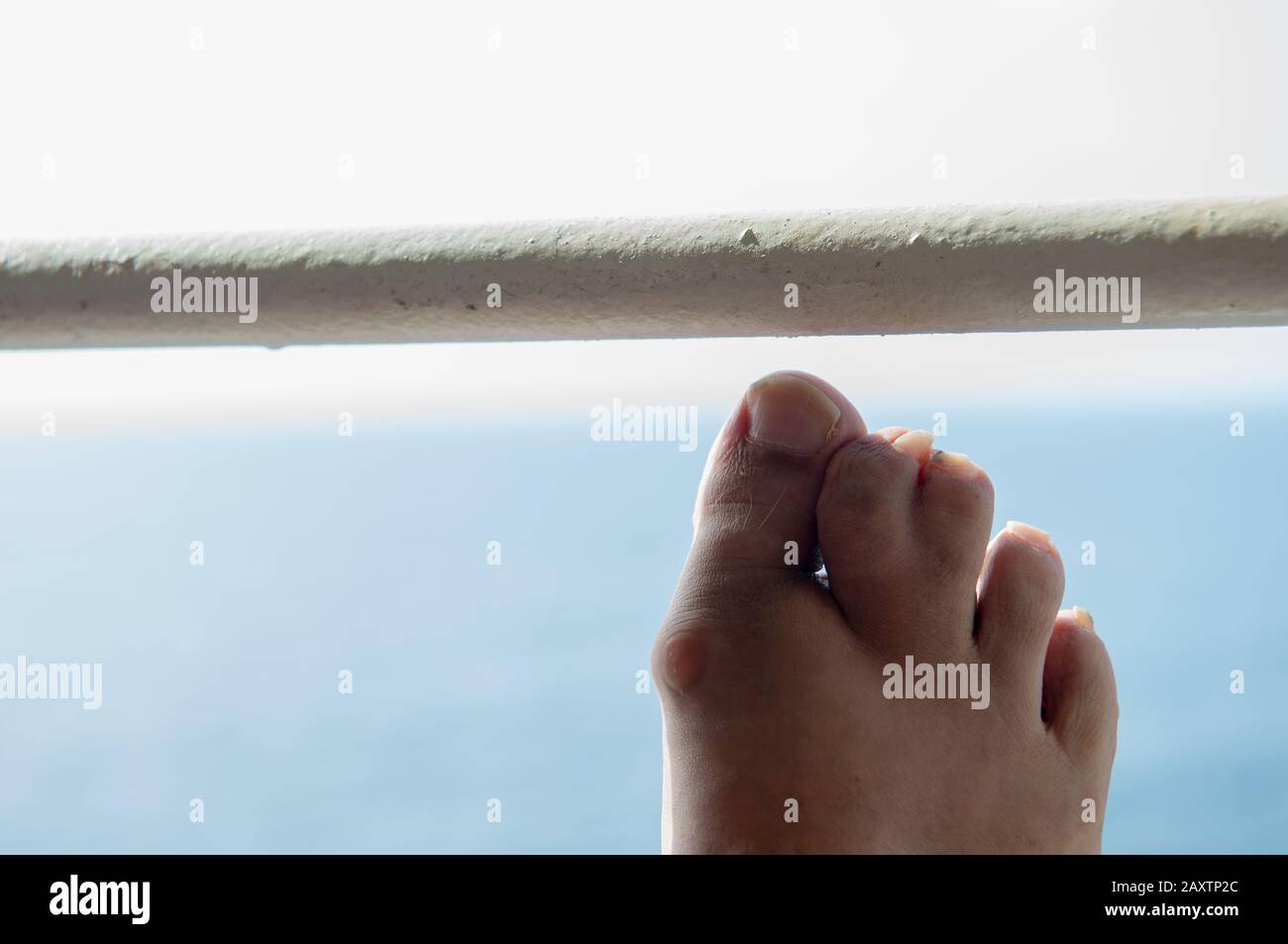 Human foot with conjoined toes Stock Photo - Alamy