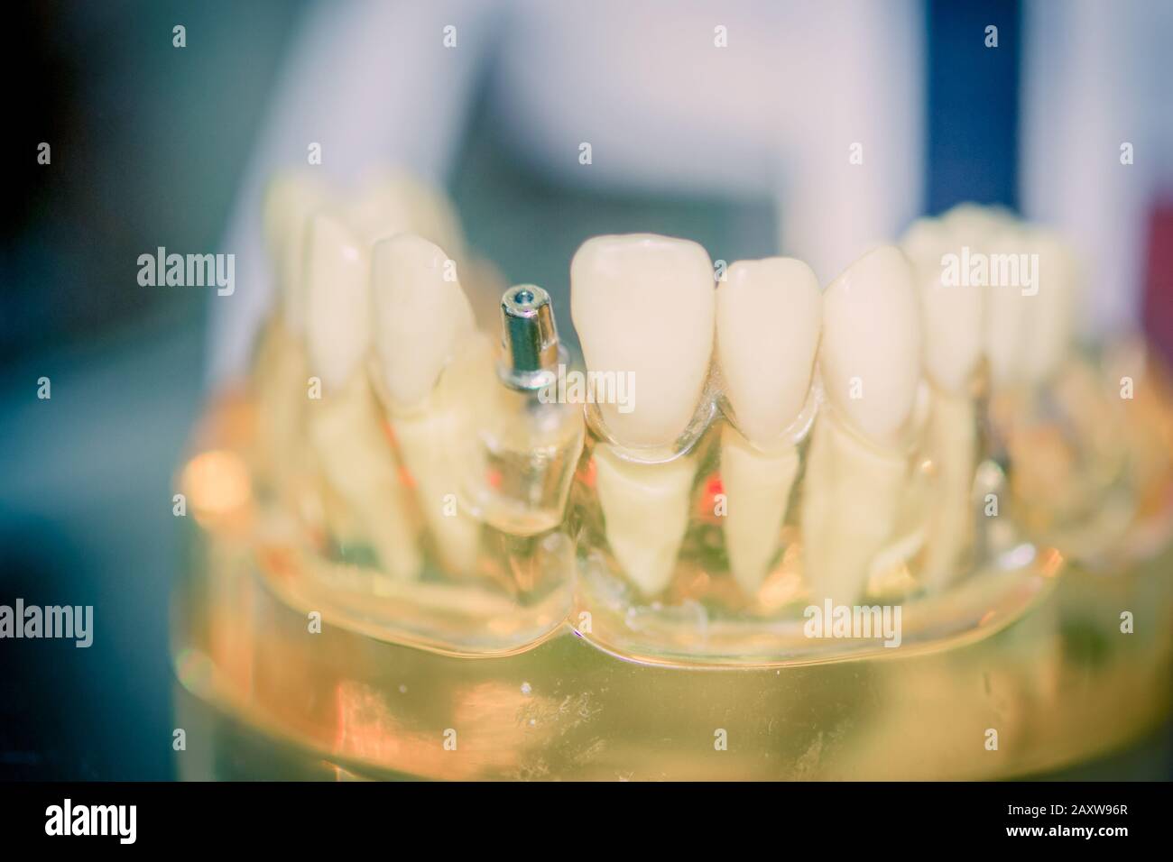 Transparent Model of Human Teeth with implants close-up Stock Photo - Alamy
