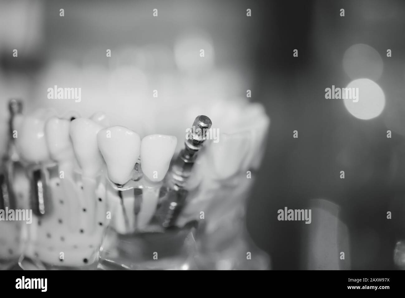 Transparent Model of Human Teeth with implants close-up Stock Photo - Alamy